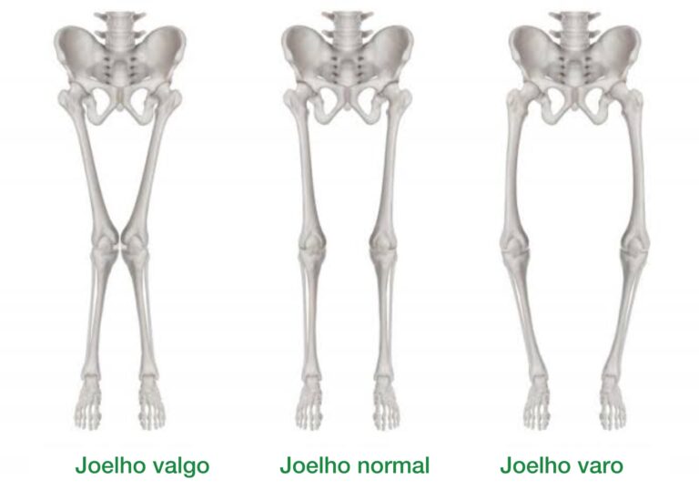 Joelho Valgo e Varo: O que São, Causas, Sintomas e Tratamentos - Dr ...
