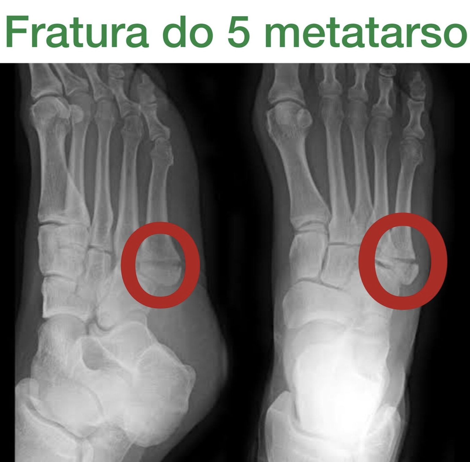 Anatomia dos Ossos do Pé: Estrutura e Função - Dr. Thiago Protta