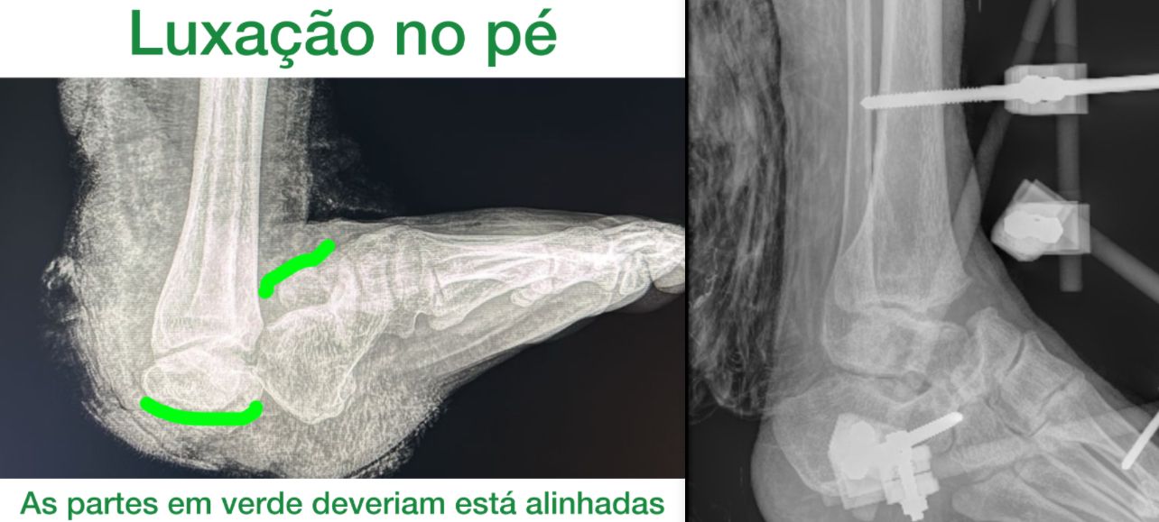 Luxação: O Que é, Causas, Sintomas e Tratamentos - Dr. Thiago Protta