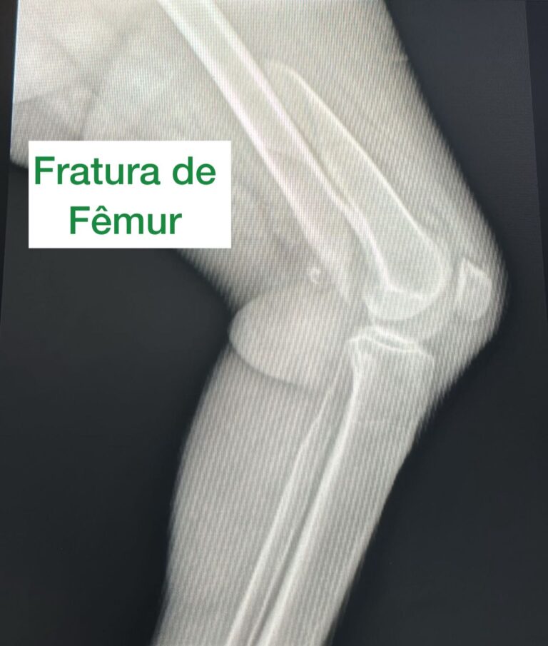 Fêmur: O Maior e Mais Forte Osso do Corpo - Dr. Thiago Protta